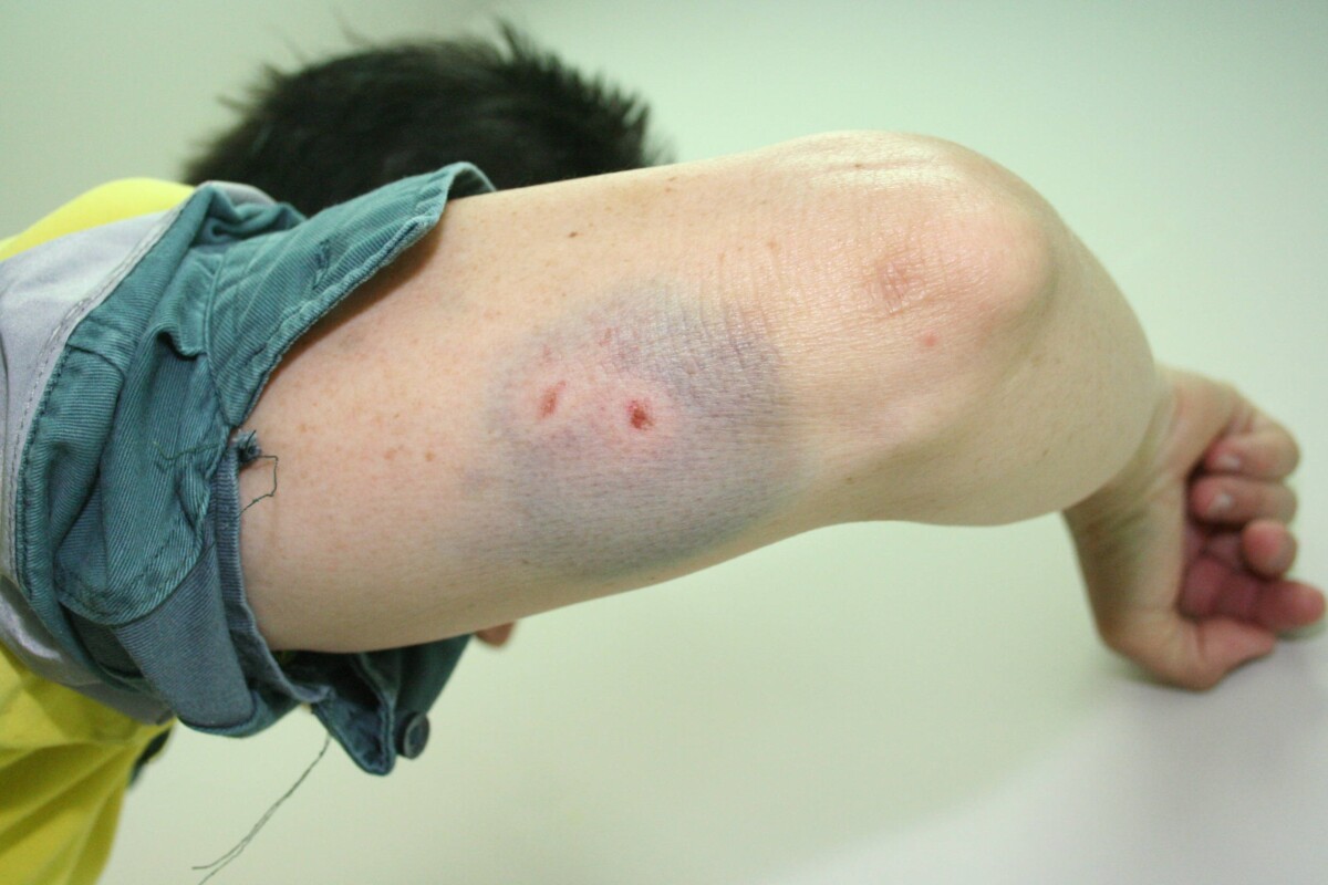 CONTENT WARNING: Dog attacks take their toll on meter readers - Energy ...